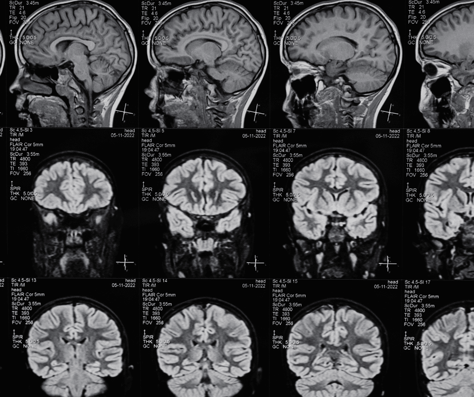 Exploring the Vital Attributes of Lawyers in Traumatic Brain Injury ...